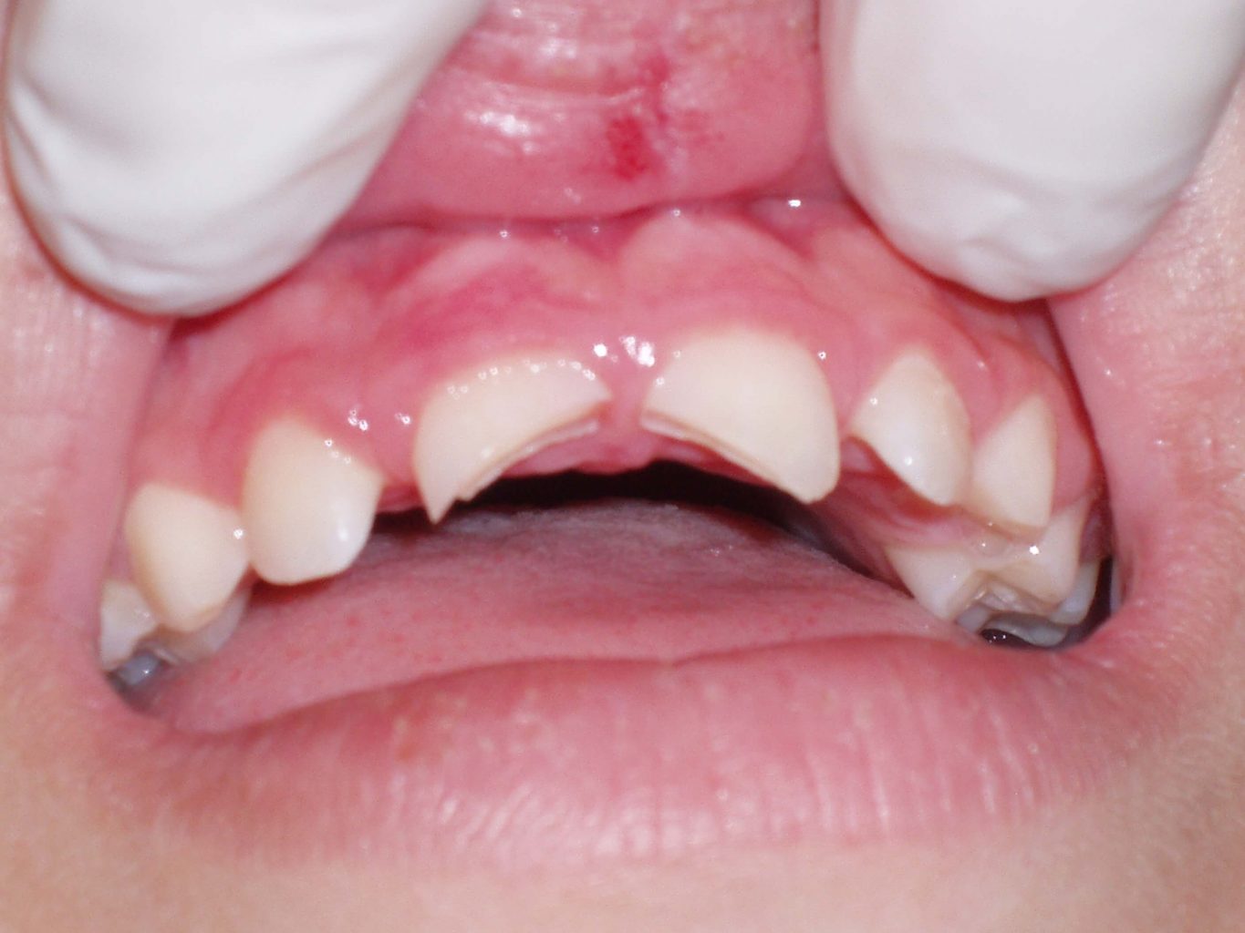 Emergency Dental Care - My child has a fractured tooth; what should I ...