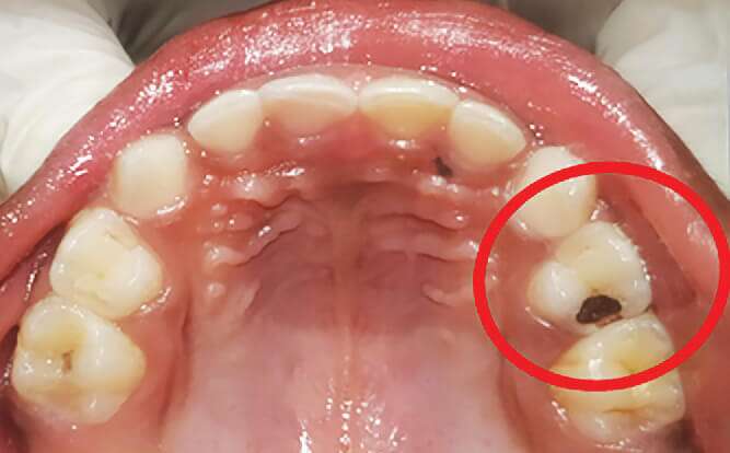What is Silver Diamine Fluoride or SDF? - Kids Teeth