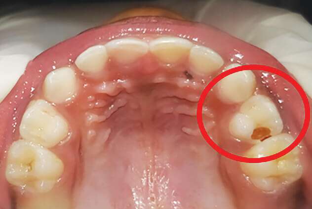 What is Silver Diamine Fluoride or SDF? - Kids Teeth